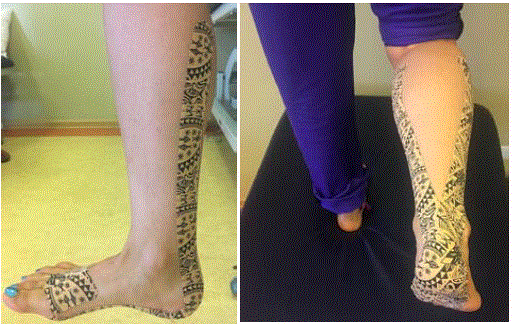 Plantar Fasciitis and Current Treatment Approaches