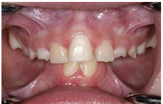 Hypoglossia with Severe Mandibular Transversal Discrepancy: A Case Report
