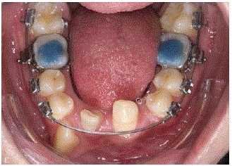 Hypoglossia with Severe Mandibular Transversal Discrepancy: A Case Report