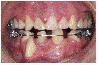 Hypoglossia with Severe Mandibular Transversal Discrepancy: A Case Report