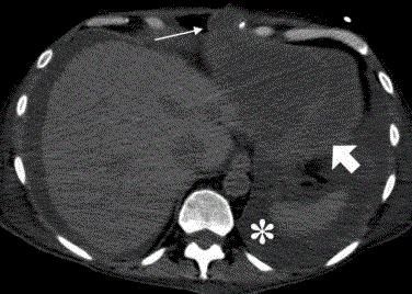 Pericardial Abscess in a Cardiac Transplant Patient