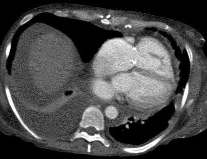 Pericardial Abscess in a Cardiac Transplant Patient