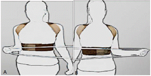 Splint Designed to be used in the “Pre- and Post-Operative” Correction ...