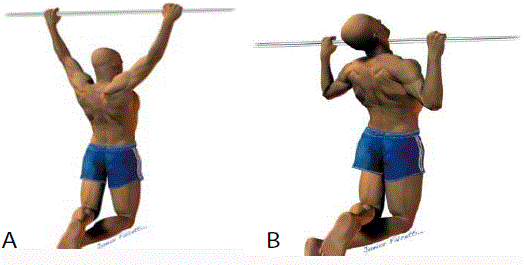 Splint Designed to be used in the “Pre- and Post-Operative” Correction ...