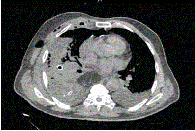 Disruption of the Staple Line in a Patient wıth Intrathoracic Gastric ...