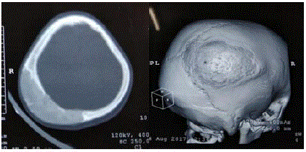 Single Stage Cranioplasty Following Calvarial Tumor Resection Using ...