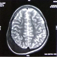 Single Stage Cranioplasty Following Calvarial Tumor Resection Using ...