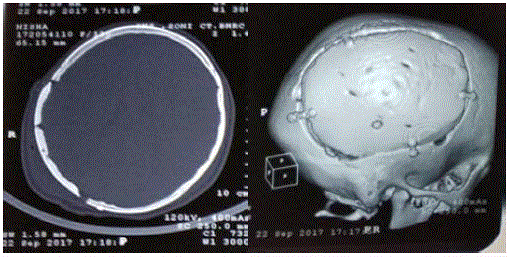 Single Stage Cranioplasty Following Calvarial Tumor Resection Using ...