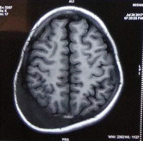 Single Stage Cranioplasty Following Benign Calvarial Tumor Resection ...