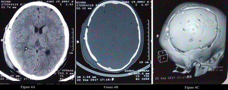 Single Stage Cranioplasty Following Benign Calvarial Tumor Resection ...