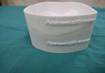 Single Stage Cranioplasty Following Benign Calvarial Tumor Resection ...