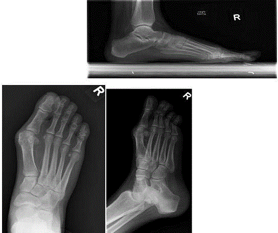 Correction of Simple Complete Syndactyly: Case Report and Operative ...