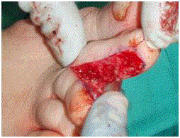 Correction of Simple Complete Syndactyly: Case Report and Operative ...