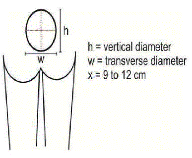 Limberg Flap Customised for Sacral Pressure Sore