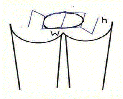 Limberg Flap Customised for Sacral Pressure Sore