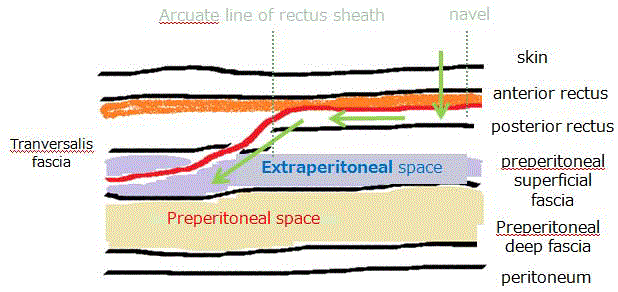 Surgical Technique of Totally Extraperitoneal Repair (TEP) for an ...