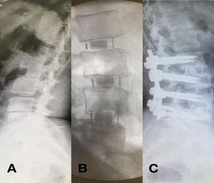 Extreme-Lateral Lumbar Inter Body (XLIF) Fusion plus Posterior ...