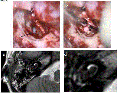Surgical Indication of Inner Ear Malformation associated with Bacterial ...
