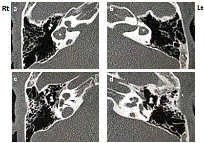Surgical Indication of Inner Ear Malformation associated with Bacterial ...