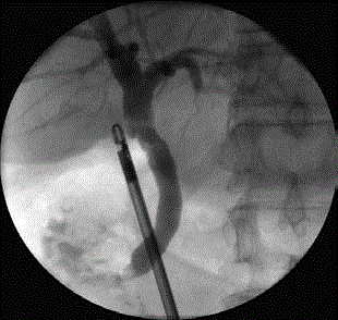 Tips and Tricks to Perform Intraoperative Cholangiogram during Single ...