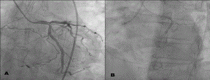 What become of the Changes of the Stuck Guide Wire during Cardiac ...