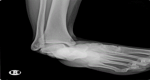Medial Peritalar Dislocation without a Fracture: A Rare Case