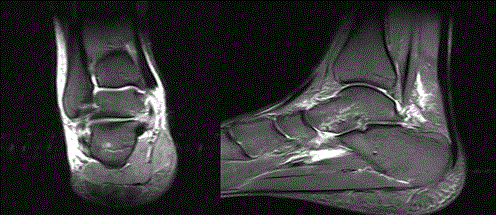 Medial Peritalar Dislocation without a Fracture: A Rare Case