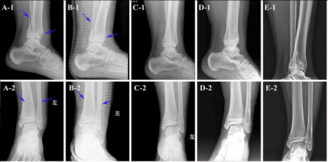 Closed Reduction Treatment and Outcome of Triplane Fracture of the ...
