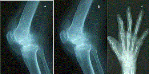 Surgery for Multicentric Reticulohistiocytosis Associated with ...