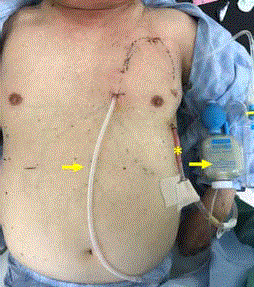 Loop-Shaped Placement of Subcutaneous Drain for Extensive Subcutaneous ...
