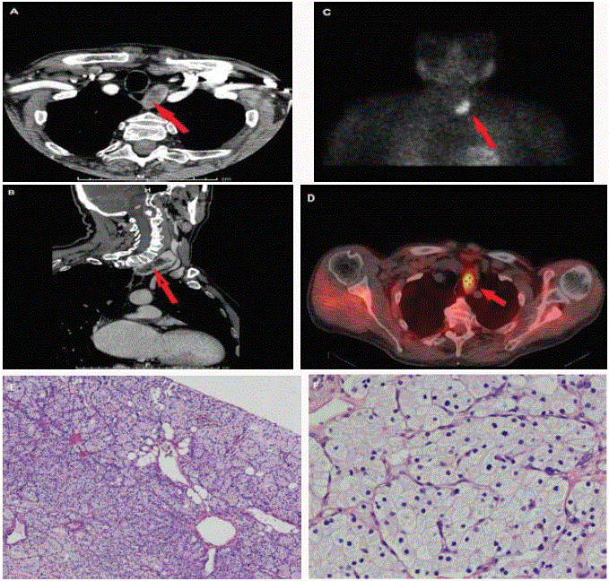 A Large Functioning Water Clear Cell Functioning Parathyroid Adenoma