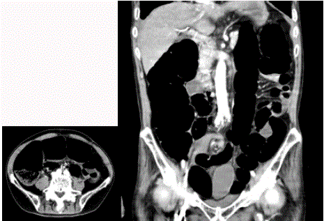 Relevance of a Persistent Descending Mesocolon to Sigmoid Volvulus