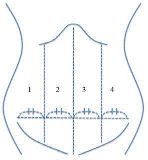 Relevance of a Persistent Descending Mesocolon to Sigmoid Volvulus