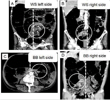 Relevance of a Persistent Descending Mesocolon to Sigmoid Volvulus
